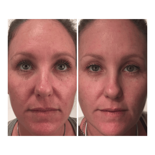 1 month of Sensitive Energize, alternating days – ZIIP™